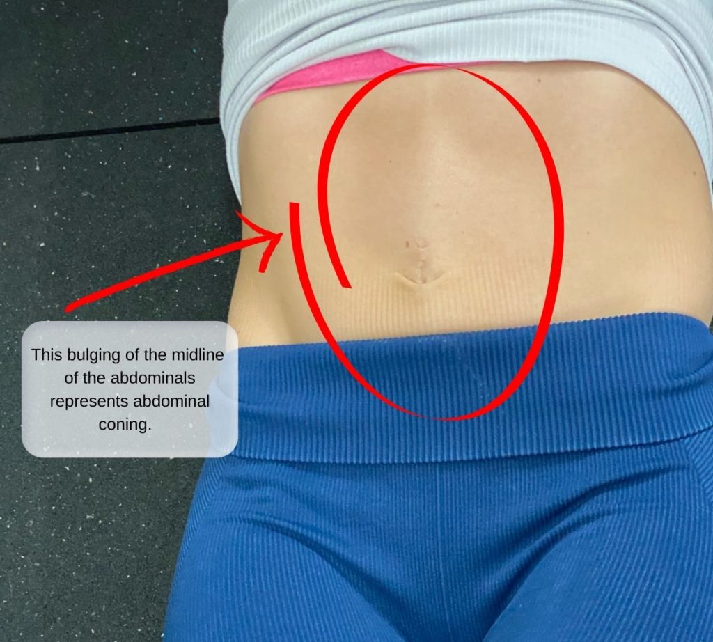 What Does Diastasis Recti Look Like Sculpt Daily