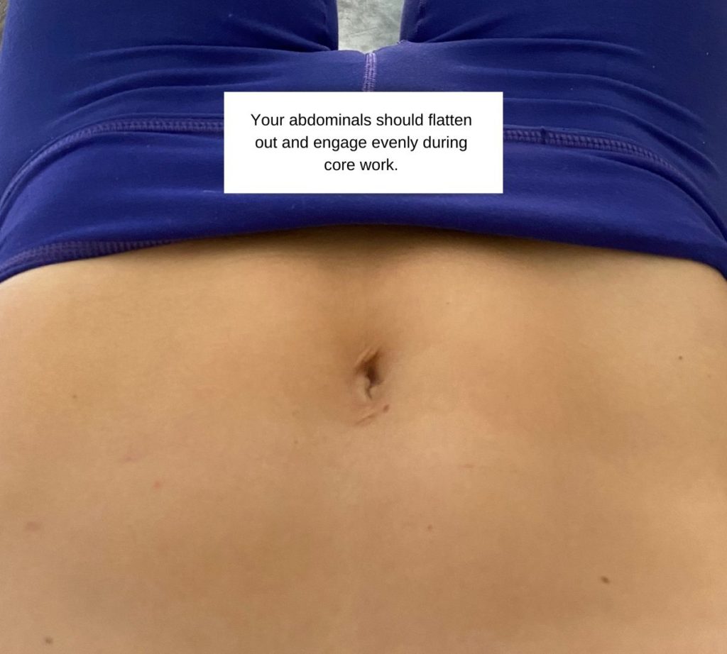 What Does Diastasis Recti Look Like? - Sculpt Daily